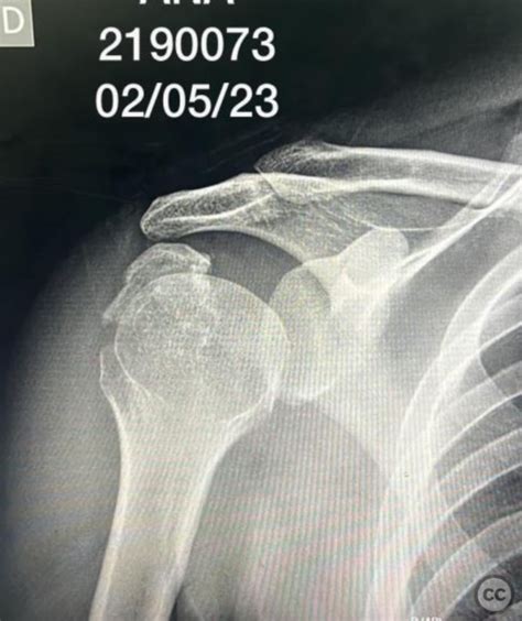 Displaced Greater Tuberosity Fracture