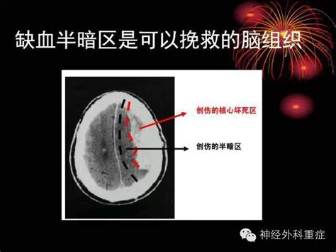 钟书教授专栏丨你还在依赖甘露醇和速尿降颅压吗 脑医汇