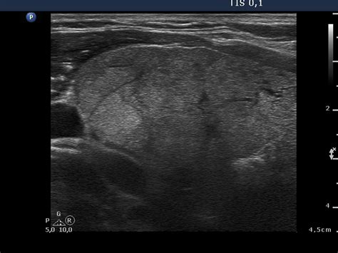 Selected Topics Differentiation Of Discrete Lesions
