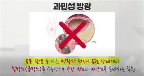 약으로도 과민성 방광 치료 안 될 땐 ‘보톡스가 답 약으로도 과민성 방광 치료 안 될 땐 ‘보톡스가 답