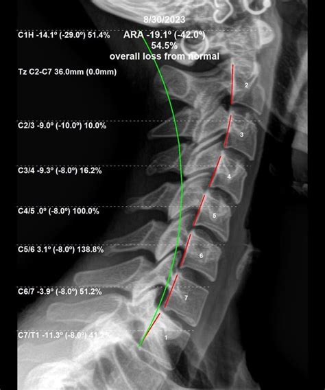 Chiropractor Told Me My Thyroid Is Calcified R Radiology