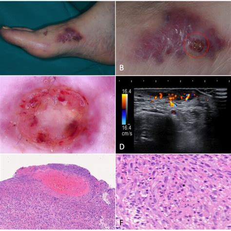 Nodular Kaposis Sarcoma A Hyperkeratotic Nodules On The Left