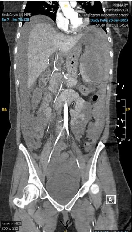 Spontaneous Splenic Rupture Associated With Influenza B Virus