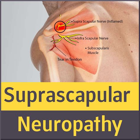 Suprascapular Neuropathy
