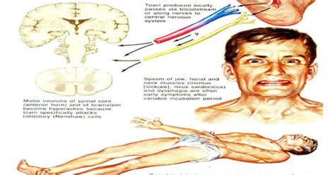 Tetanus Symptoms Recognizing The Signs Of A Silent Threat
