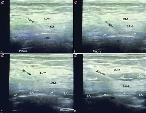 Combined Serratus Anterior Plane Block A Anatomical Scene Before The Download Scientific