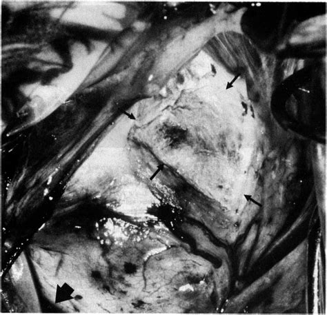 Photograph Of A Partial Thickness Scleral Resection Small Arrows At