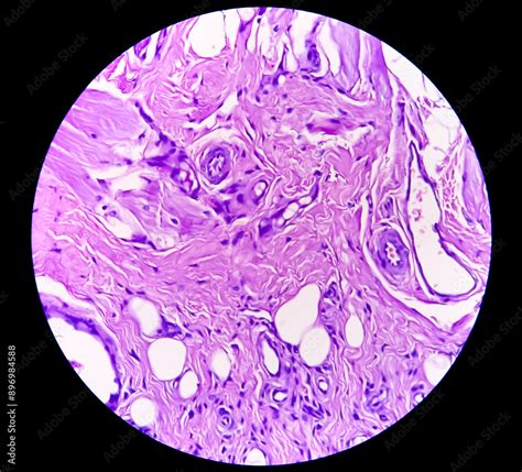 Microscopic Examination Showing Leukoplakia Buccal Mucosa Leukoplakia