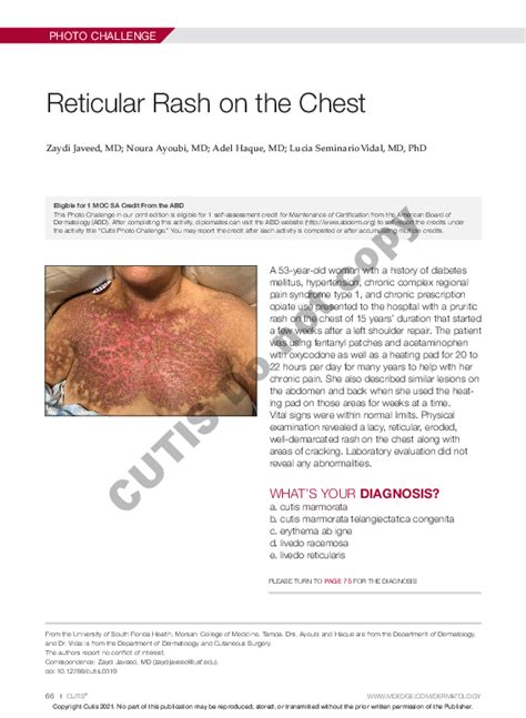 Pdf Reticular Rash On The Chest Adel Haque Pdf Reticular Rash On The Chest Adel Haque