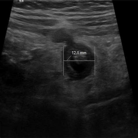 Longitudinal Ultrasound Image Shows An Inflamed Appendix With Marked