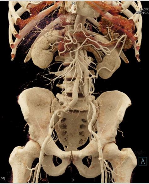 Osama Ammar Msc On Linkedin Cinematicrendering Healthcare 3dimaging Ml Computervision