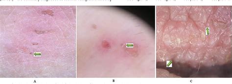 Skin Scraping For Scabies