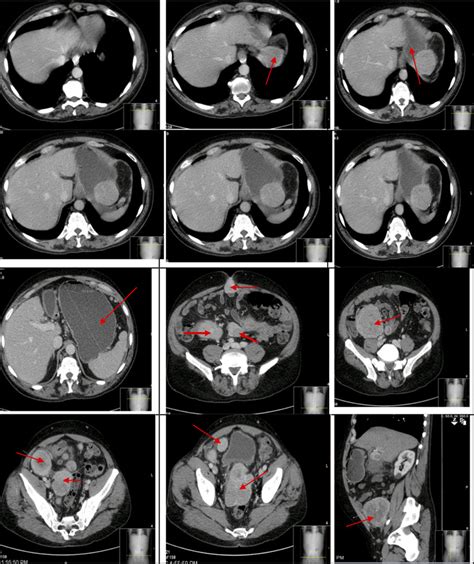 Ct Abdomen And Pelvis After Administration Of 94 Ml Of Omnipaque 350