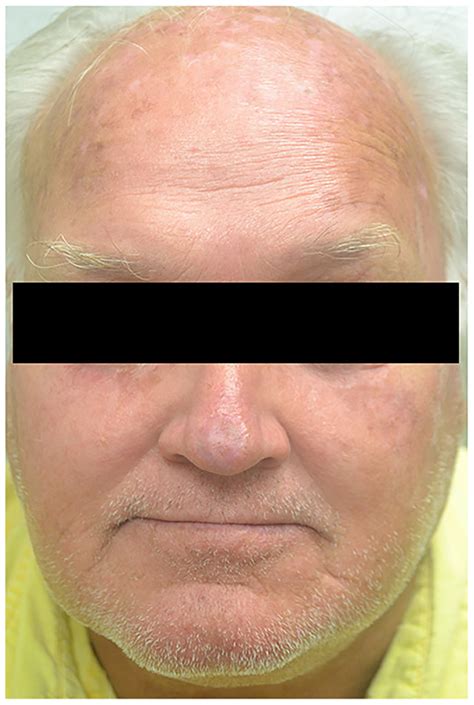 Photodynamic Therapy Effectively Treats Actinic Keratoses Without Pre