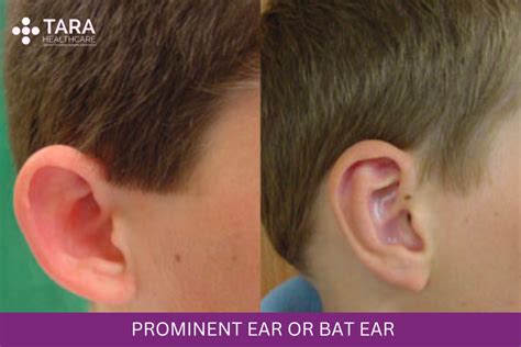 Bat Ear Medical At Abby Thorn Blog