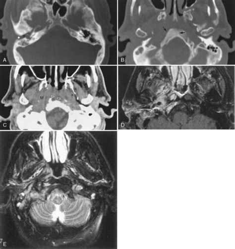 Temporal Bone Neupsy Key