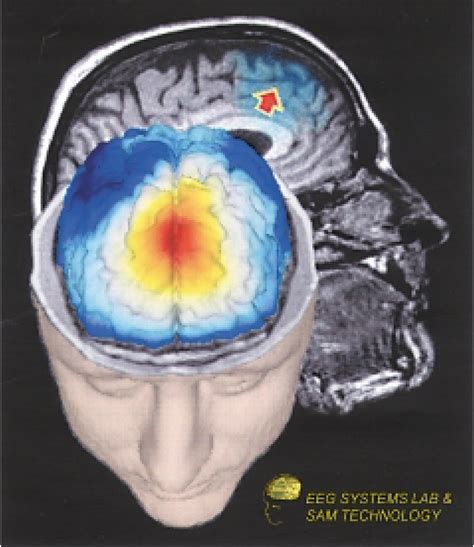 Localization Of An Eeg Dipole Model In The Somatosensory Cortex Of The Download Scientific