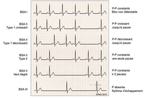 Dysfonction Sinusale Bloc Sino Atrial — Uness Cardiologie