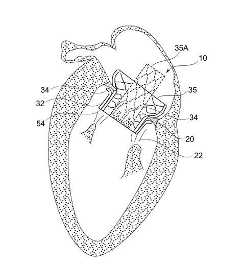 Prosthetic Mitral Valve Patented Technology Retrieval Search Results