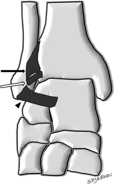 Anatomy Of The Anterior Syndesmosis A Representation Of The Anterior