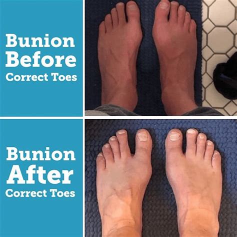 Correct Toes® Australia The Worlds Best Toe Spacer Natural Foot Health
