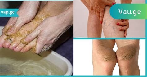 შეიზილეთ ეს პროდუქტი ფეხებზე და დაემშვიდობეთ ვენების ვარიკოზს