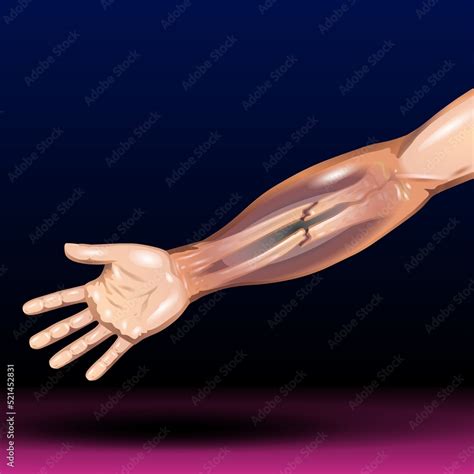 Hand Bone Fracture Distal Radius Fracture And Broken Arm Bone Types Anatomy Vector