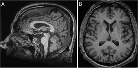 Cerebral Mri From Sal 394 048 After 10 Years Of Ataxia Duration