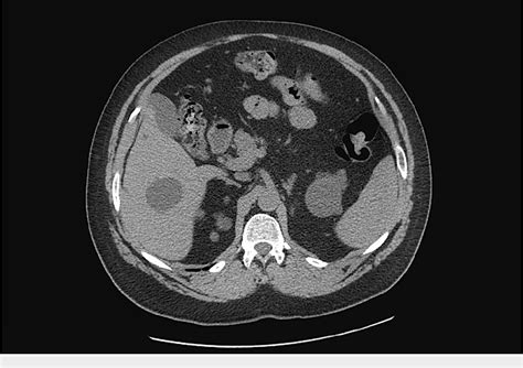 Figure 3 From An Unexpected Association Of Primary Biliary Cholangitis In A Male Patient With