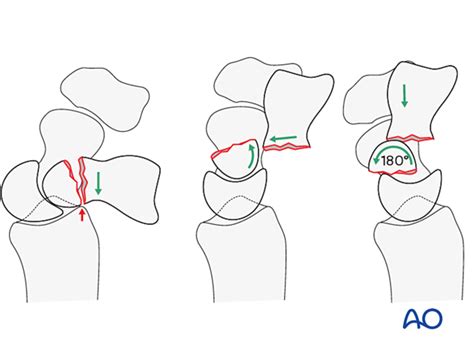 Screw Fixation Of A Capitate Fracture