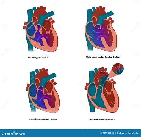 Tetralogy Of Fallot Composition Of The Heart Defects Vector
