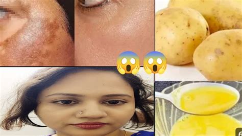 আলুর রসের সাথে ২টি উপাদান মিশান স্কিনের কালো দাগ মেছতা চোখের নিচের কালো