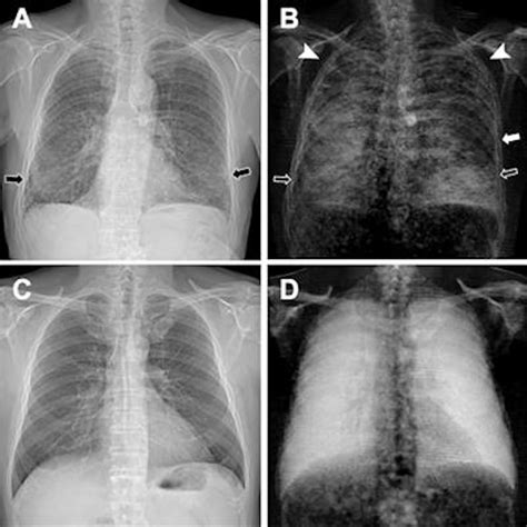 Dark Field Chest X Ray Differentiates Lung Disease Auntminnie