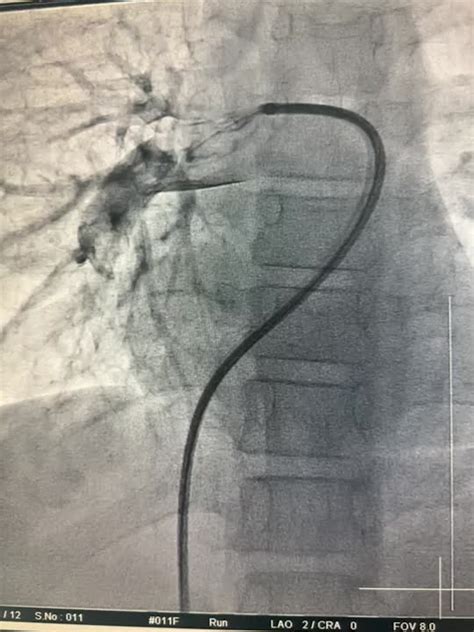Video Dr Abdul Sattar Shaikh Mbbs Mcpsfcpspedsfcpsped Cardfaccfscai Chpe On