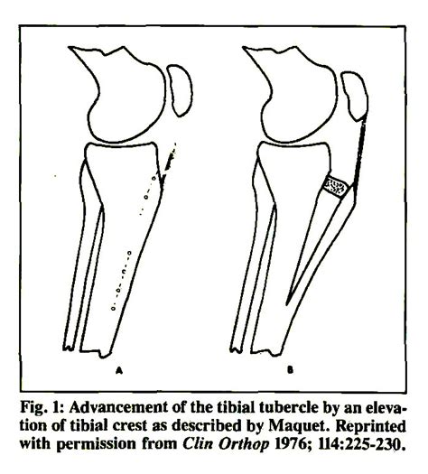 Tibial Tubercle Advancement