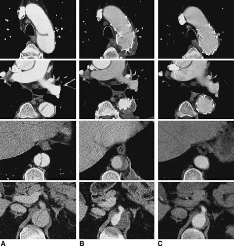 Contrast Enhanced Ct Of Acute Type B Dissection A And Comparable Ct Download Scientific
