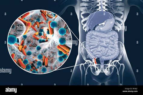 Appendicitis Illustration Of A Human Appendix Showing It Red And Inflamed In Appendicitis And