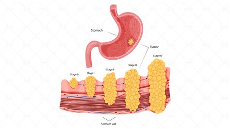 Stomach Cancer Stages Graphics Motion Array