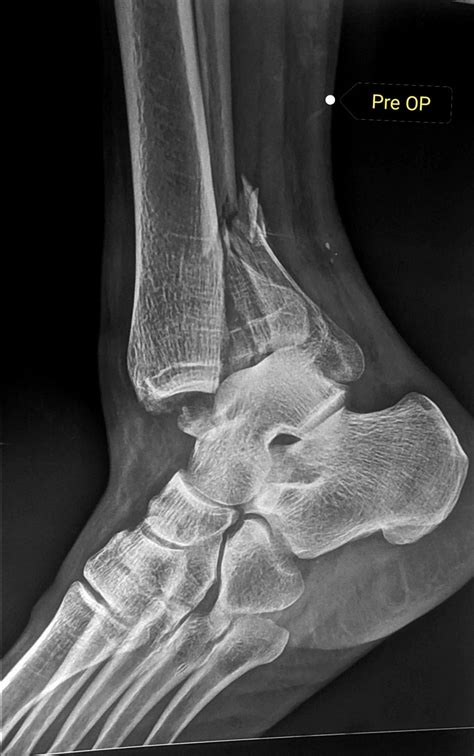 Hasith Chathuranga On Linkedin Radiology Radiographer Radiologictechnologist Dayinthelife…