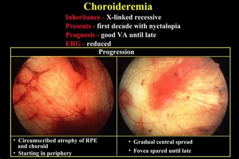 47 Hereditary Choroidal Dystropathies Ppt Eye And Vision Conditions