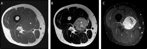 Liposarcoma Radiology Imaging Of Liposarcoma Classification Patterns