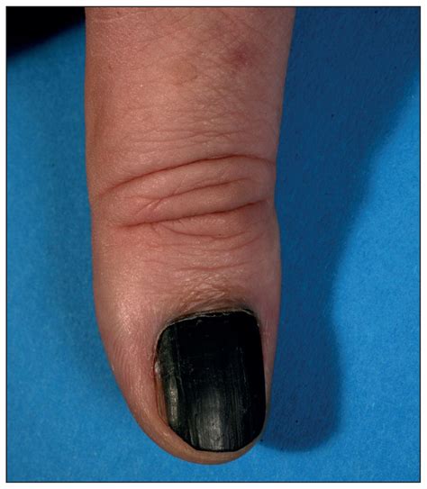Early Subungual Melanoma