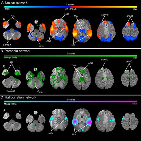 Lesion Network Mapping Highlights Regions Associated With Paranoia And Download Scientific