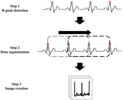 Preprocessing Free Convolutional Neural Network Model For Arrhythmia
