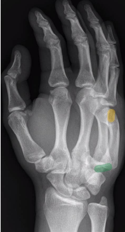 R Hand Metacarpal Fracture Dislocation Prereduction Radiograph Annotated JETem JETem