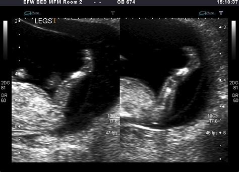 Blair S Girls NT Scan