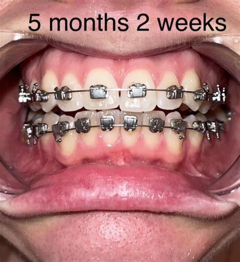 Braces Timeline First Week To Almost 6 Months Adult Braces U Mysterious Courage73