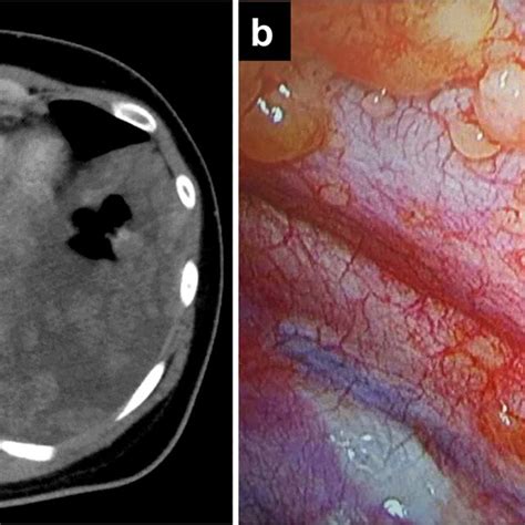 A Patient With Extraskeletal Myxoid Chondrosarcoma Metastasizing To The Download Scientific