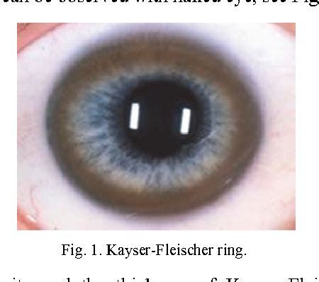 Fleischers Ring Cornea