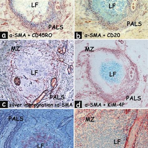 Immunohistochemistry A Double Immunostaining Of α Sma Brown And Download Scientific Diagram